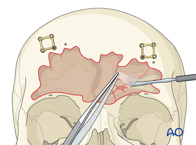 Cranialization for Frontal sinus fracture, posterior table