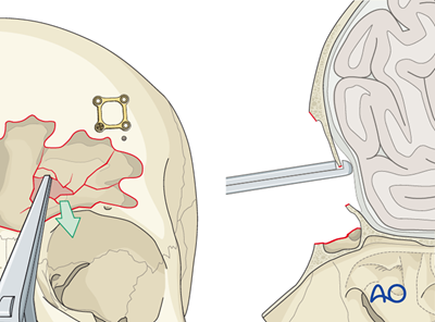 Cranialization for Frontal sinus fracture, posterior table