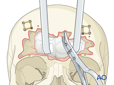 Cranialization for Frontal sinus fracture, posterior table