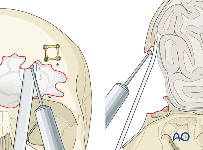 Cranialization for Frontal sinus fracture, posterior table