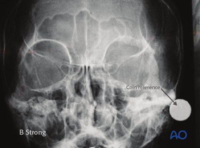 Obliteration for Frontal sinus fracture, posterior table
