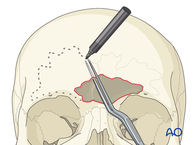 Obliteration for Frontal sinus fracture, posterior table