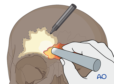 Cranialization for Frontal sinus fracture, posterior table