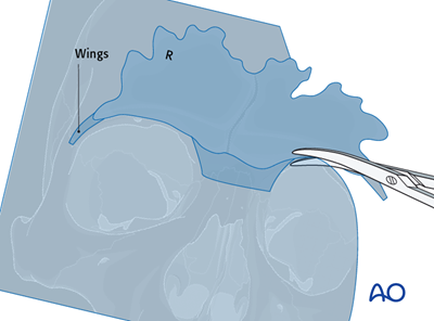 Obliteration for Frontal sinus fracture, posterior table