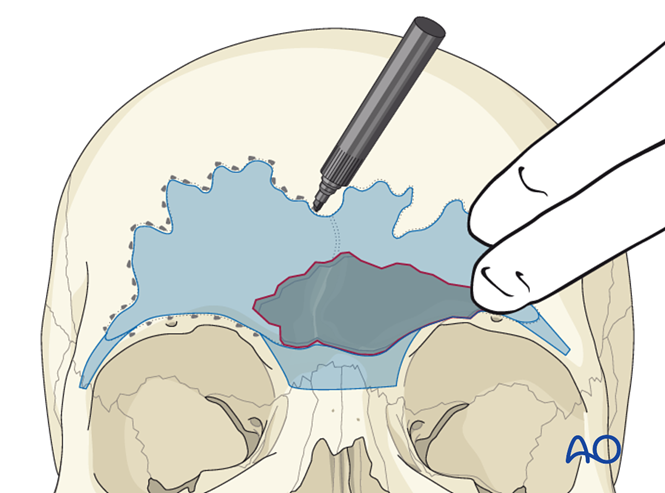 Obliteration for Frontal sinus fracture, posterior table