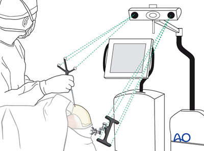 Cranialization for Frontal sinus fracture, posterior table
