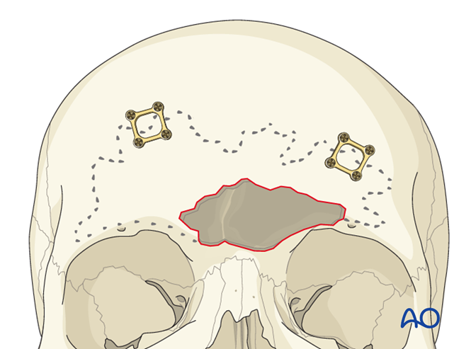 Obliteration for Frontal sinus fracture, posterior table