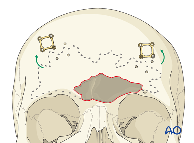 Cranialization for Frontal sinus fracture, posterior table