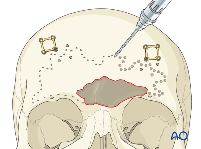 Obliteration for Frontal sinus fracture, posterior table