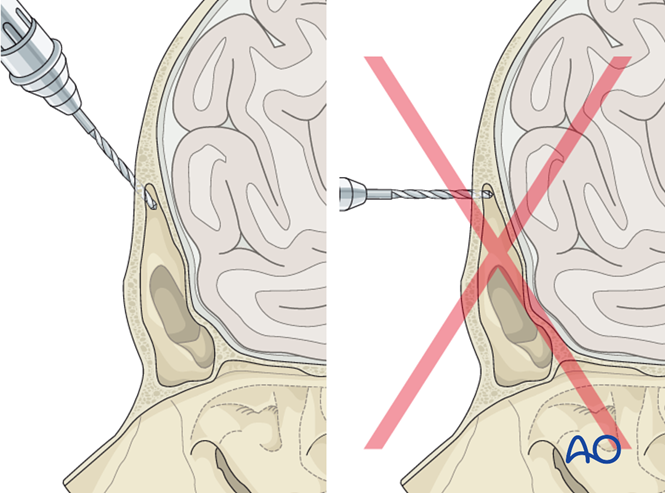 Obliteration for Frontal sinus fracture, posterior table