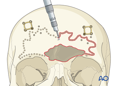 Cranialization for Frontal sinus fracture, posterior table