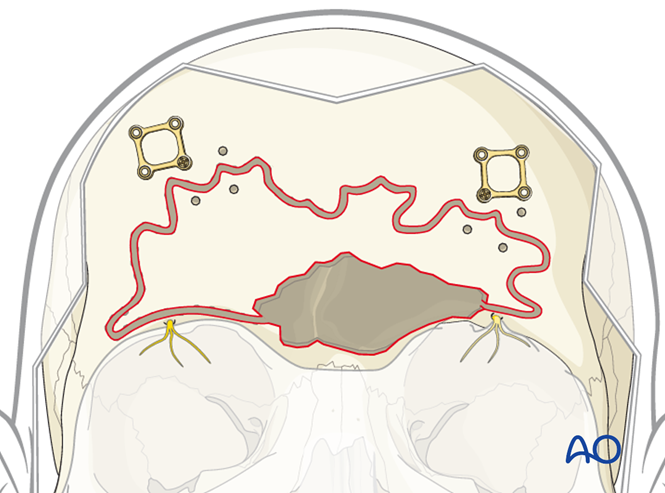 Cranialization for Frontal sinus fracture, posterior table
