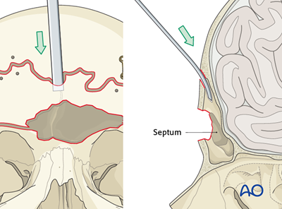Obliteration for Frontal sinus fracture, posterior table