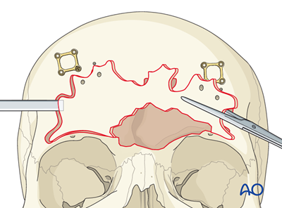 Obliteration for Frontal sinus fracture, posterior table