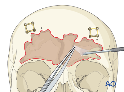 Obliteration for Frontal sinus fracture, posterior table