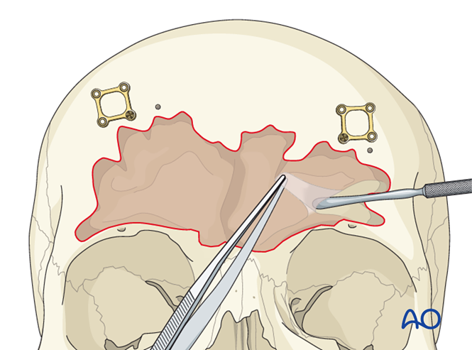 Obliteration for Frontal sinus fracture, frontal recess