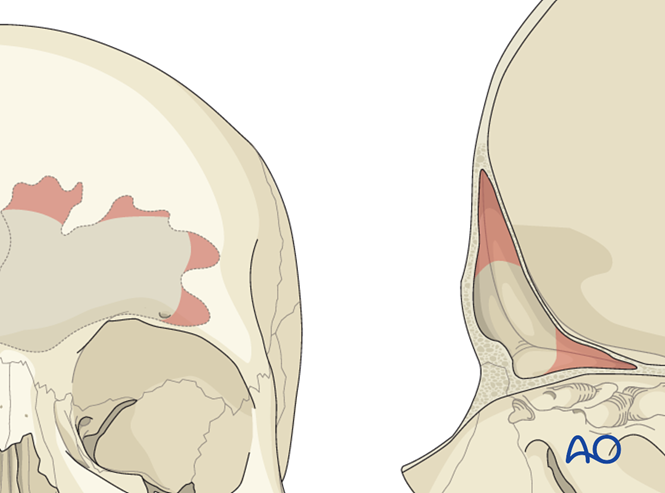 Cranialization for Frontal sinus fracture, posterior table