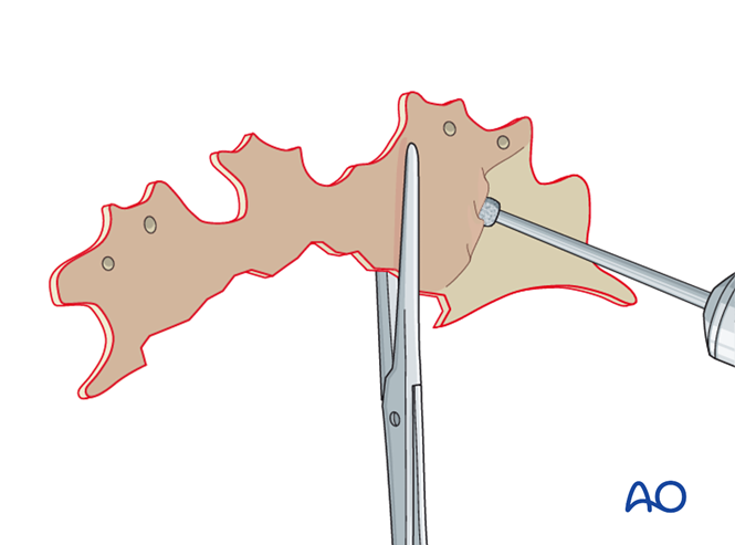 Obliteration for Frontal sinus fracture, posterior table