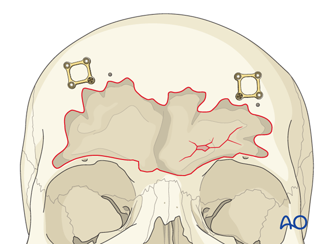 Obliteration for Frontal sinus fracture, posterior table
