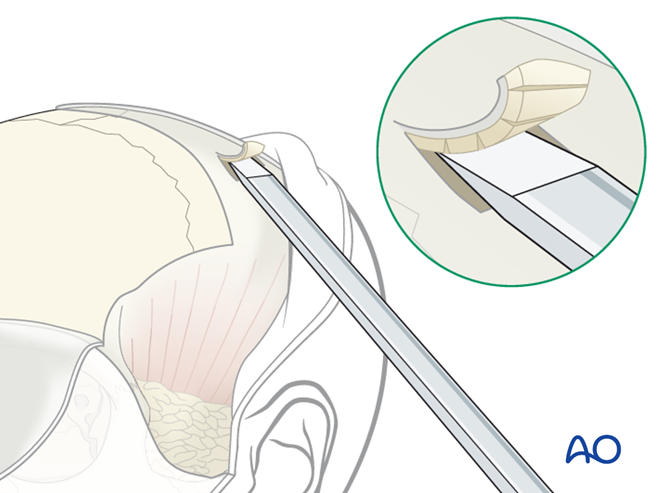 Cranialization for Frontal sinus fracture, posterior table