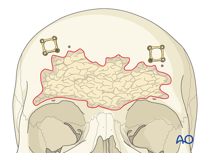 Obliteration for Frontal sinus fracture, posterior table