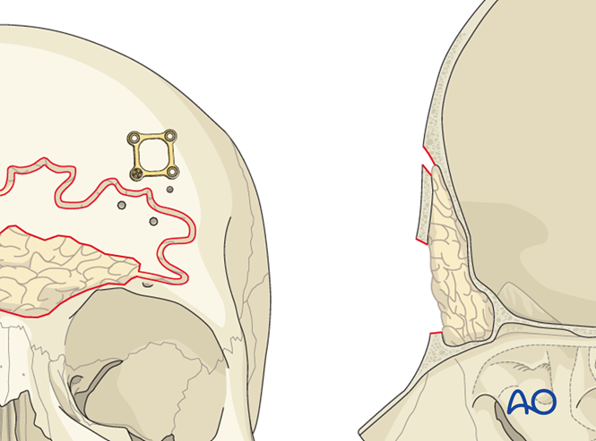 Obliteration for Frontal sinus fracture, posterior table