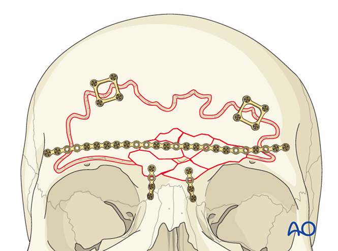 Obliteration for Frontal sinus fracture, posterior table