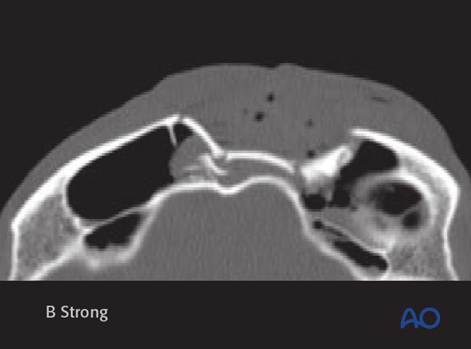 Frontal sinus fracture, frontal recess