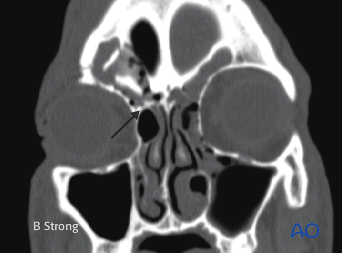 Frontal sinus fracture, anterior table
