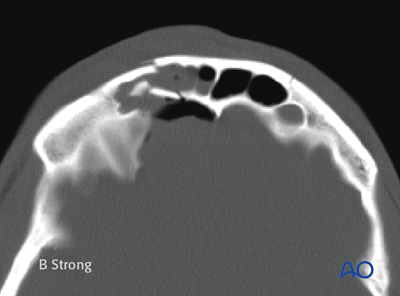 Frontal sinus fracture, frontal recess