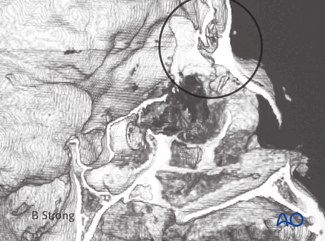 Frontal sinus fracture, frontal recess