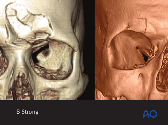 Frontal sinus fracture, frontal recess