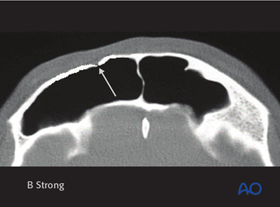 Indications for surgery