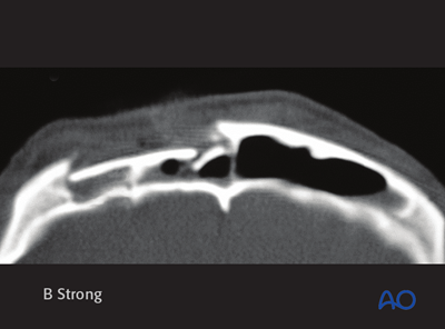 Frontal sinus fracture, frontal recess