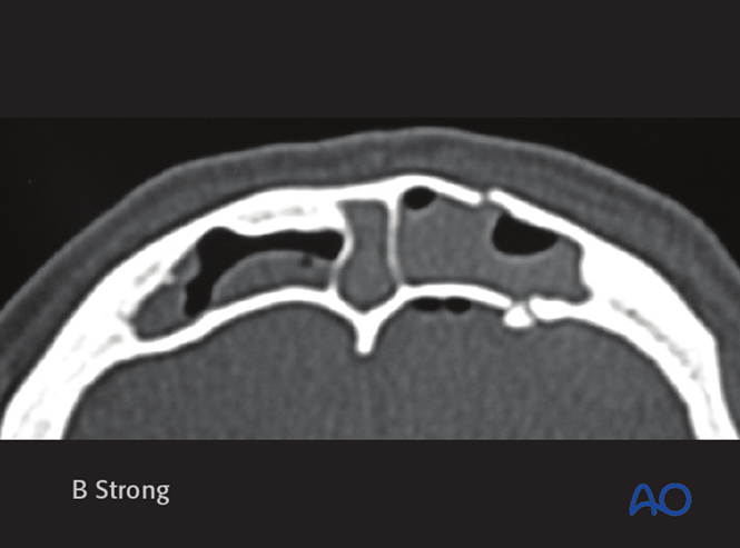 Frontal sinus fracture, frontal recess