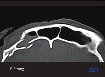 Frontal sinus fracture, posterior table