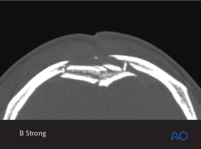 Frontal sinus fracture, frontal recess