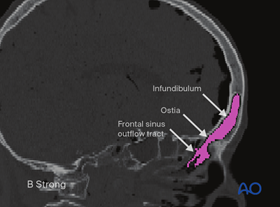 Frontal sinus fracture, frontal recess