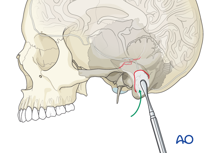 Surgical management for Temporal bone (lateral skull base)