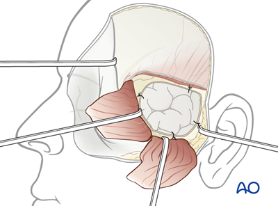 Extradural middle fossa repair using temporal fascia flap for Skull ...
