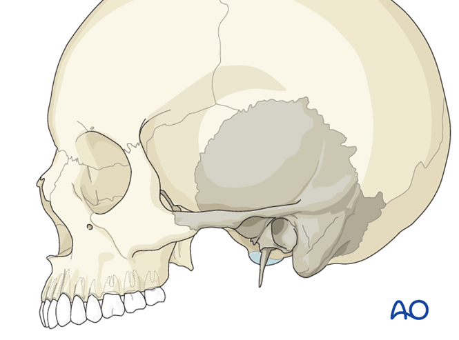 Skull base fracture, temporal bone