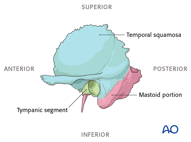 Skull base fracture, temporal bone