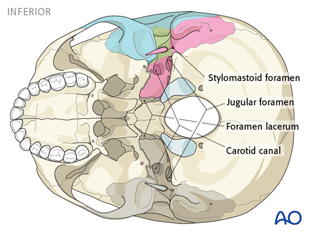 Skull base fracture, temporal bone