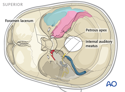 Skull base fracture, temporal bone