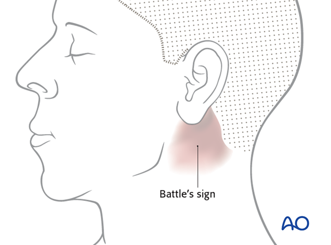 Skull base fracture, anterior