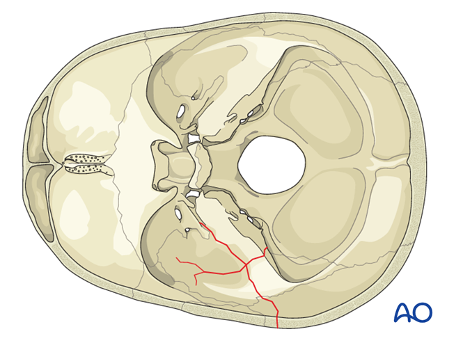 Skull base fracture, temporal bone