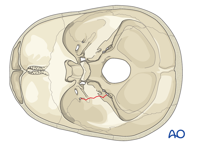 Skull base fracture, temporal bone
