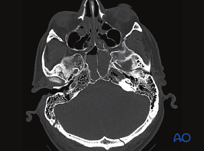 Skull base fracture, temporal bone