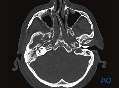 Skull base fracture, temporal bone