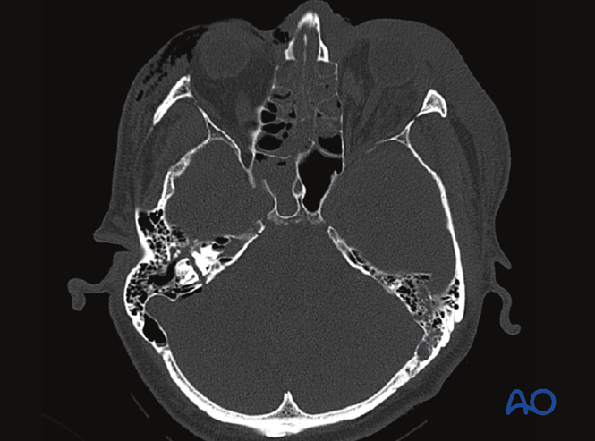 Skull base fracture, temporal bone